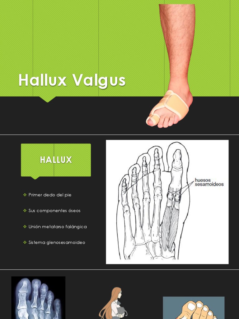 Clasificación del Hallux Valgus | PDF | Dedo del pie | Sistema ...