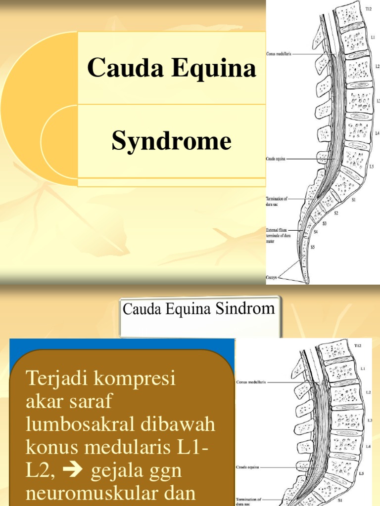 Cauda Equina Sindrome | PDF