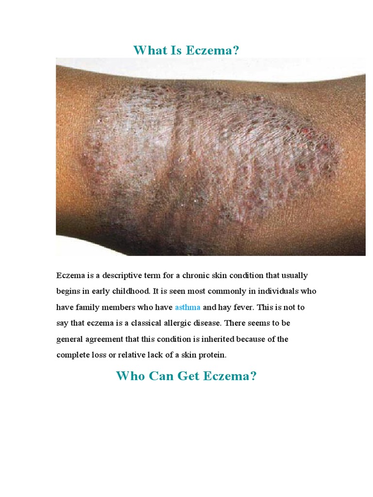 What Is Eczema | PDF | Dermatitis | Topical Medication
