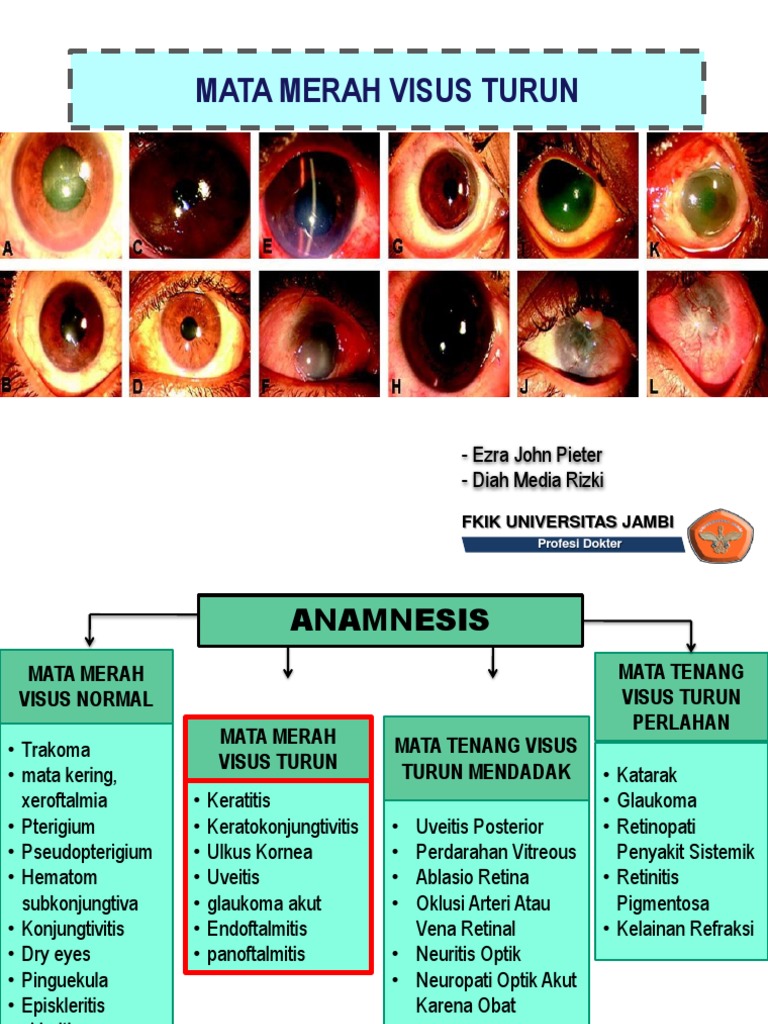 Mata Merah Visus Turun Mendadak | PDF