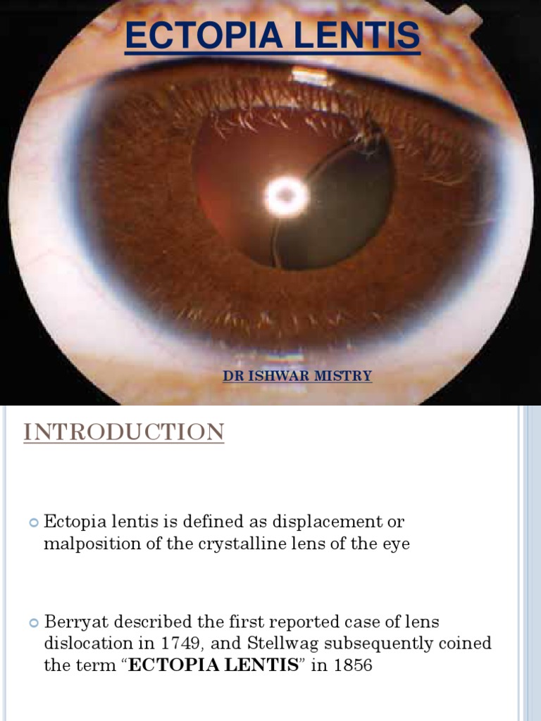 Ectopia Lentis Pdf Glaucoma Ophthalmology