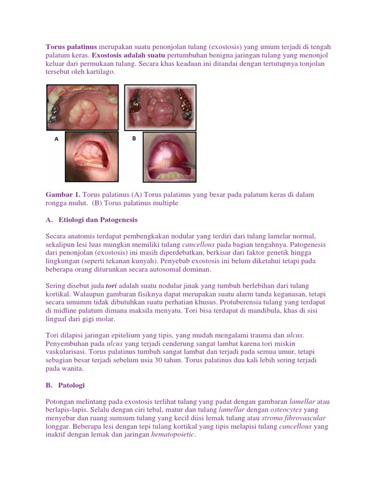 Torus Palatinus | PDF