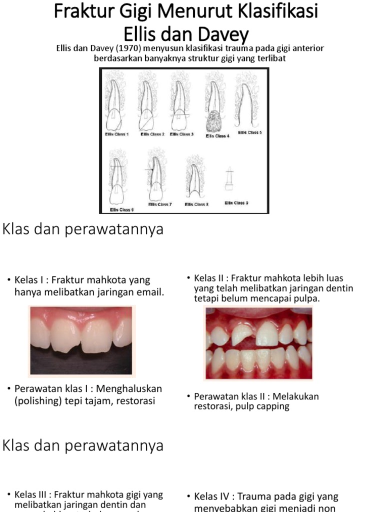Fraktur Gigi Menurut Klasifikasi Ellis Dan Davey