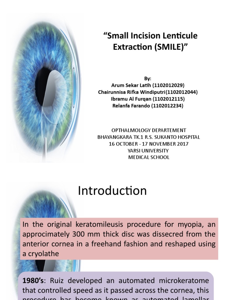 Small Incision Lenticule Extraction (SMILE): An Analysis of a New Flap ...