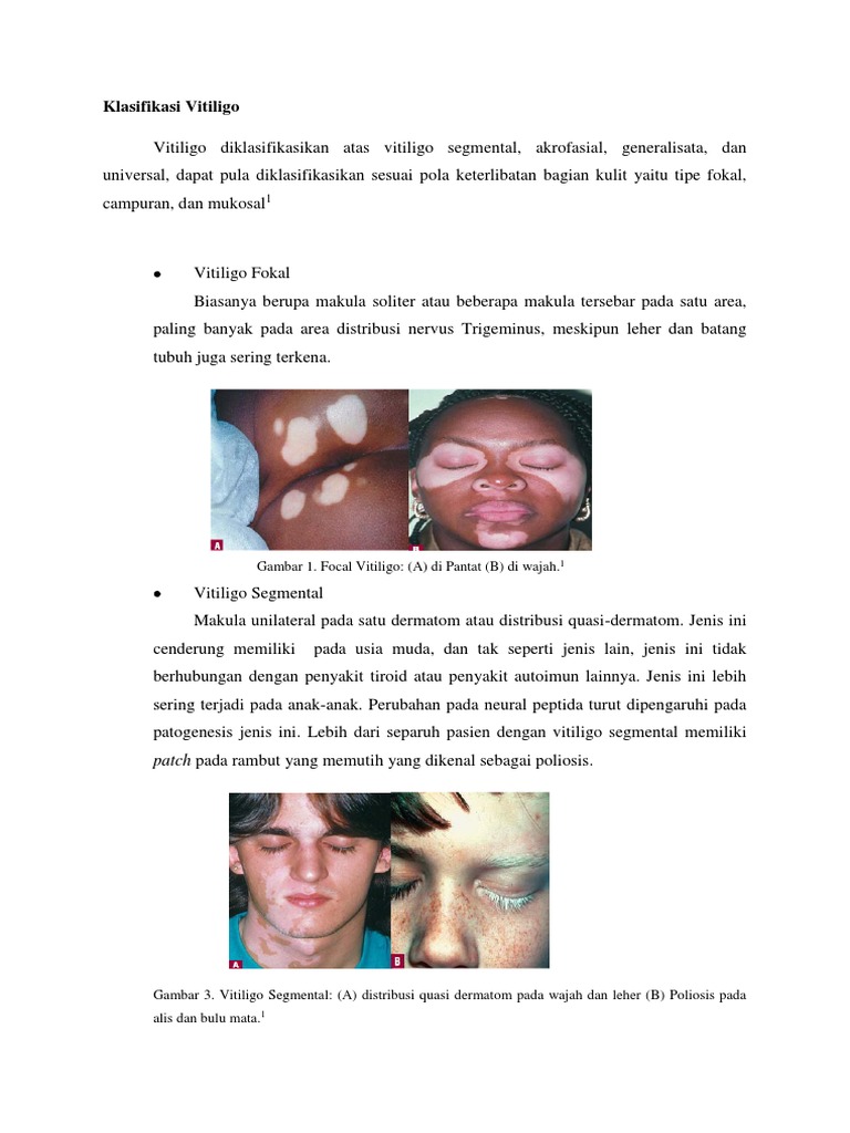 Klasifikasi Vitiligo | PDF
