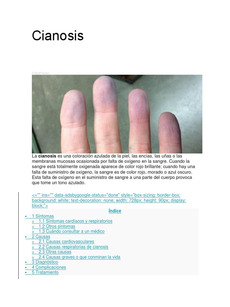 Cianosis | Enfermedades y trastornos | Medicina