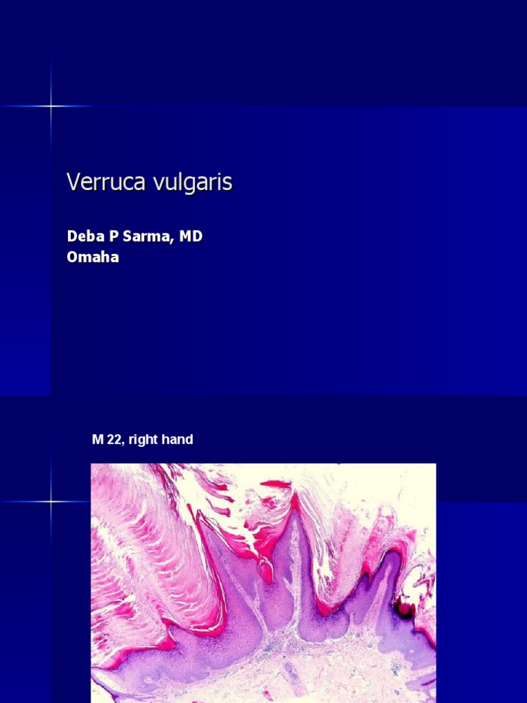 Verruca Vulgaris., M 22. | PDF
