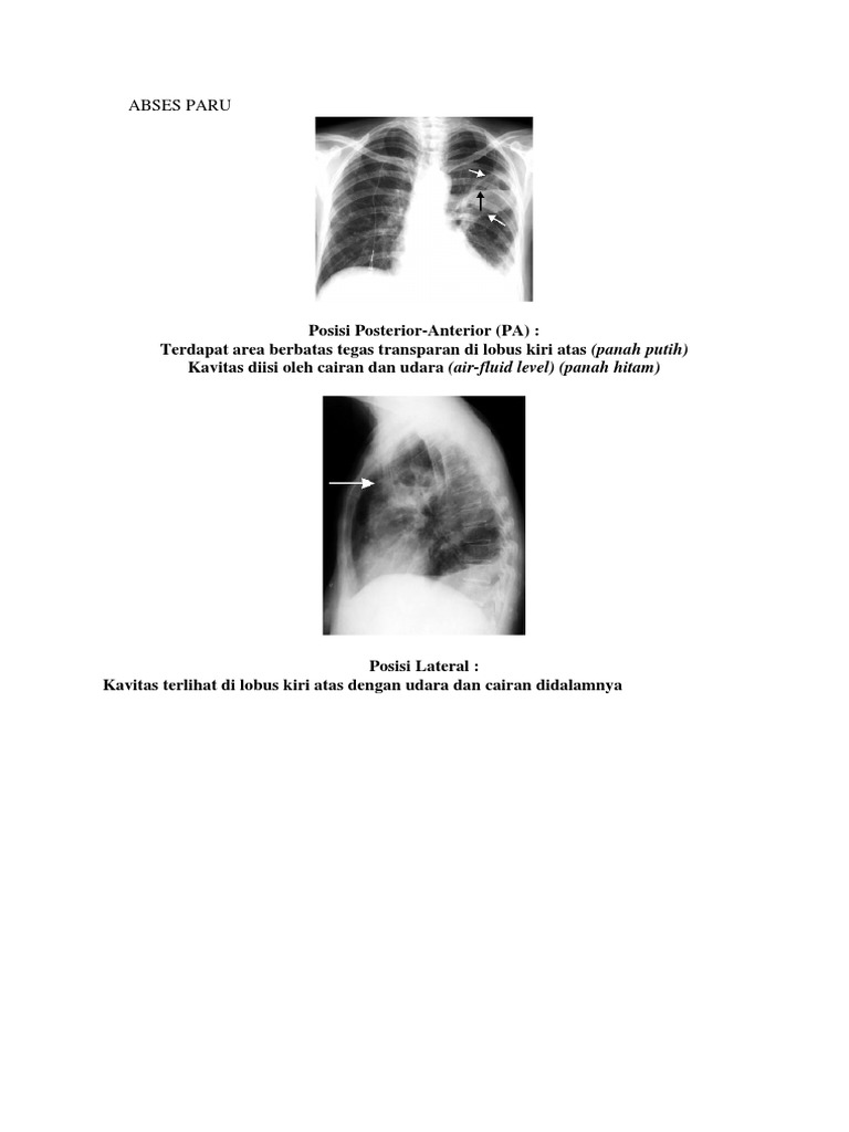 Abses Paru | PDF