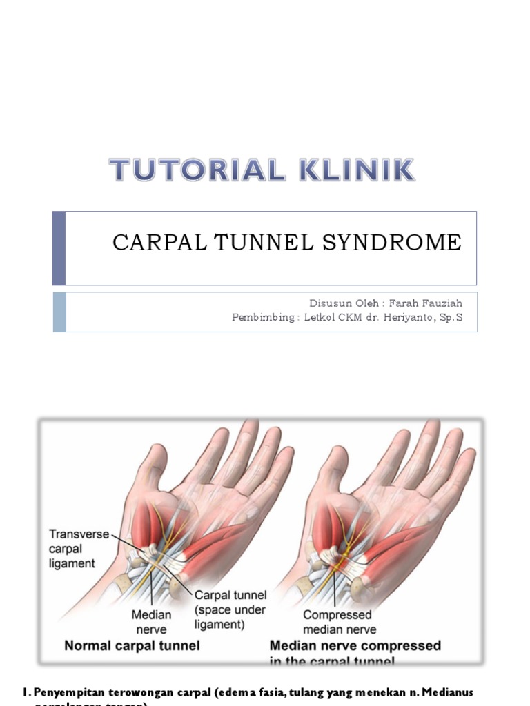 Carpal Tunnel Syndrome: Penyebab, Gejala, Diagnosis, dan Penanganannya ...