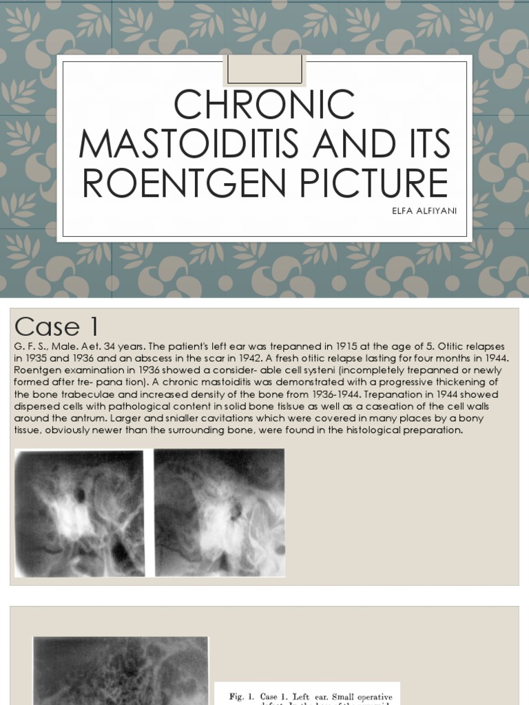 Chronic Mastoiditis: Roentgen Findings | PDF | Anatomy | Medicine