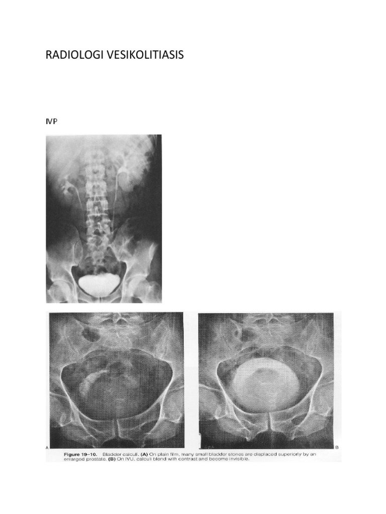 Radiologi Vesikolitiasis | PDF