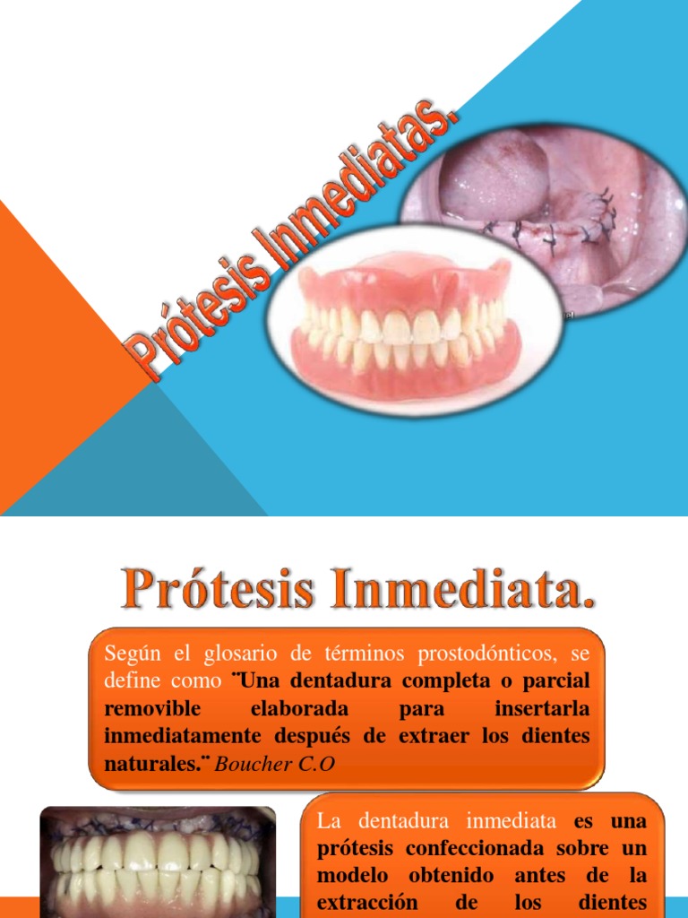 Protesis Inmediata | PDF | Dentadura postiza | Odontología
