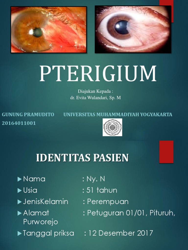 Pterigium | PDF