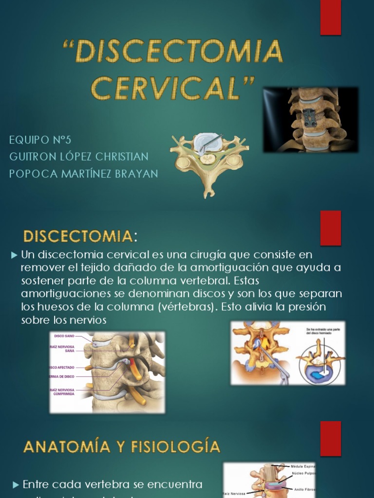 Discectomía Cervical: Procedimiento y Recuperación | PDF | La columna ...
