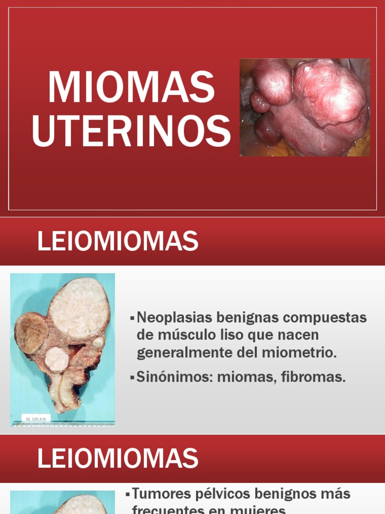 MIOMATOSIS | PDF | Útero | Ginecología