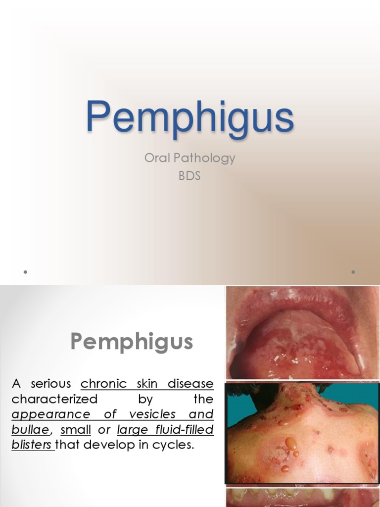 Pemphigus Vulgaris | PDF | Cutaneous Conditions | Immune System Disorders