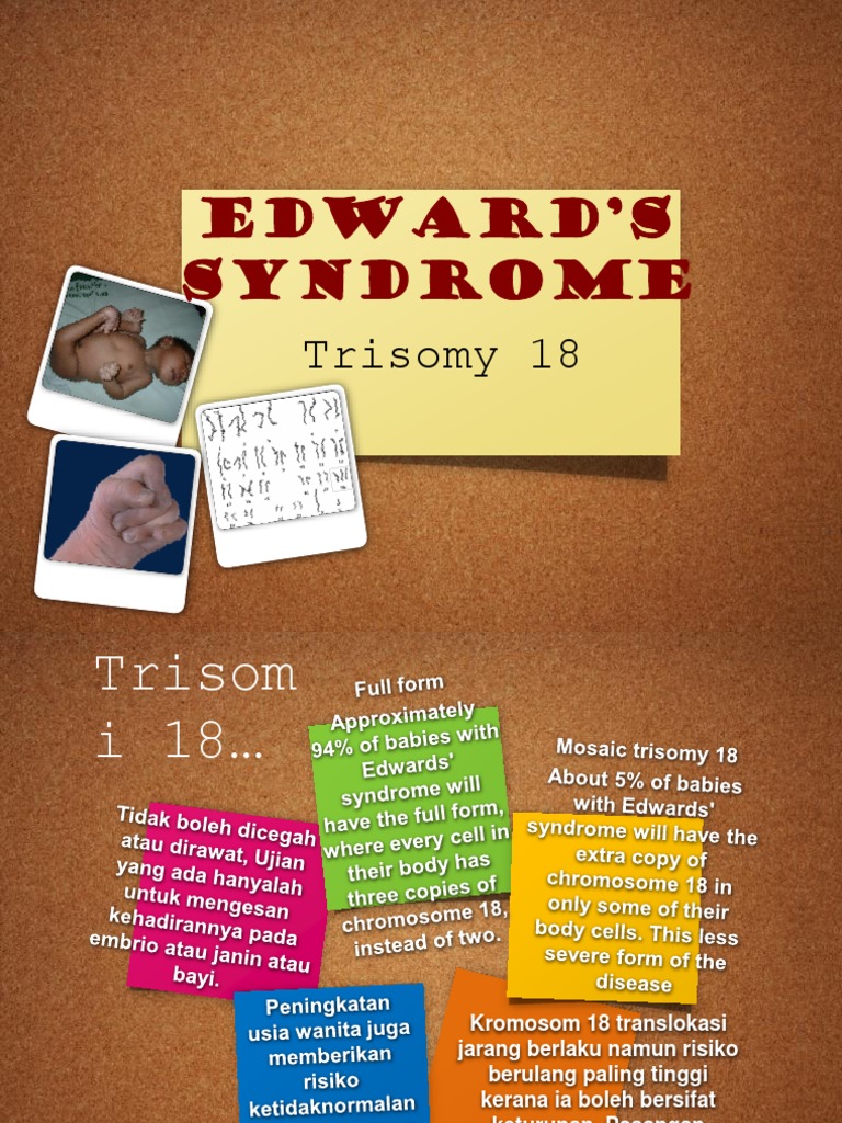 Understanding Edwards' Syndrome (Trisomy 18) | PDF