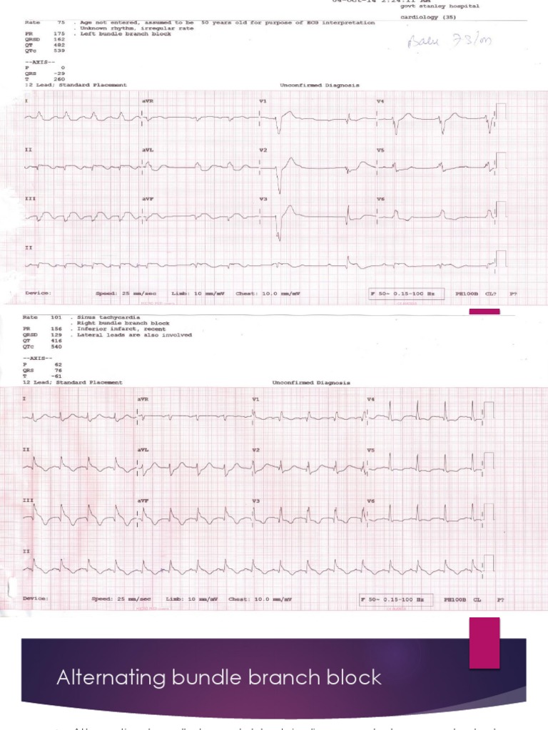 Alternating Bundle Branch Block | PDF | Electrocardiography ...
