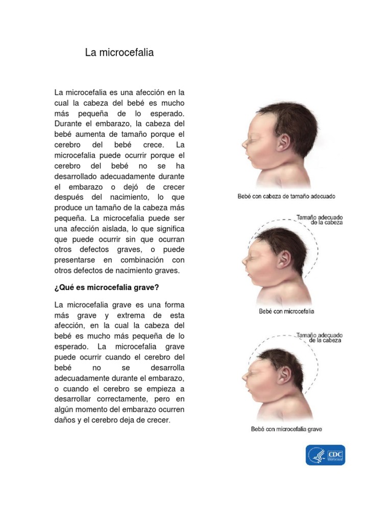La Microcefalia | PDF | Infantes | El embarazo