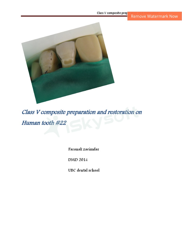 Class V Composite Preparation and Restoration On Human Toothpdf | PDF ...
