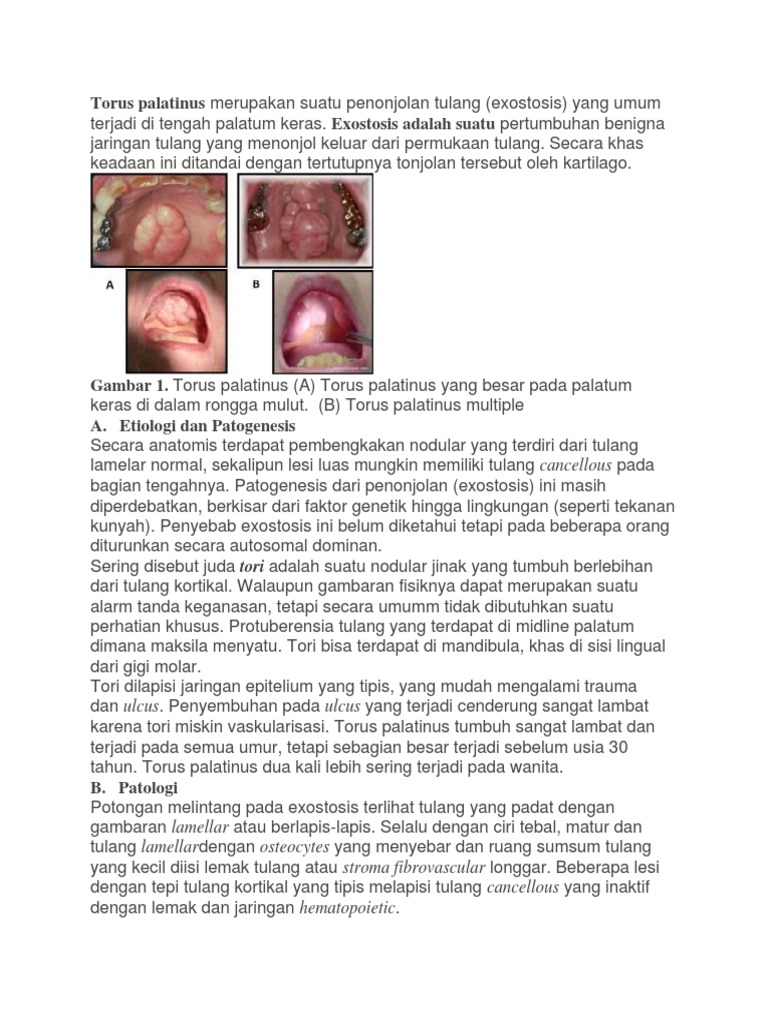 Torus Palatinus | PDF