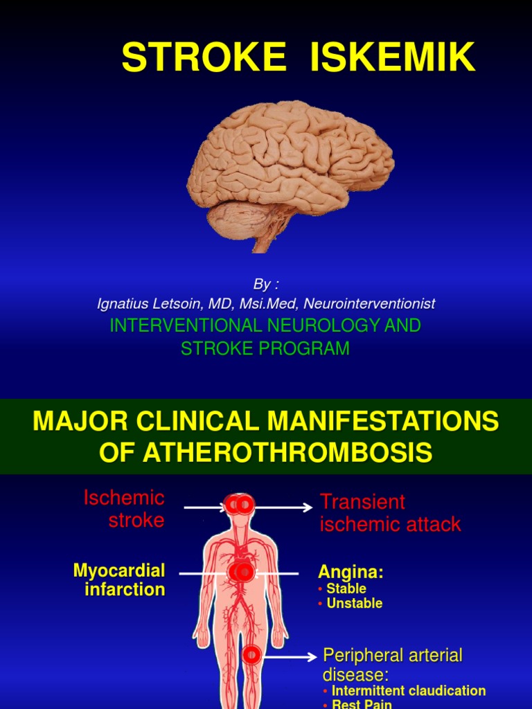 Stroke Iskemik | PDF
