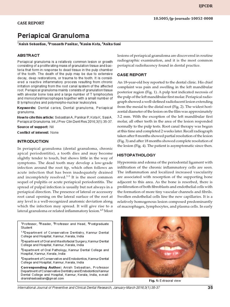 Periapical Granuloma | PDF | Dental Anatomy | Dentistry