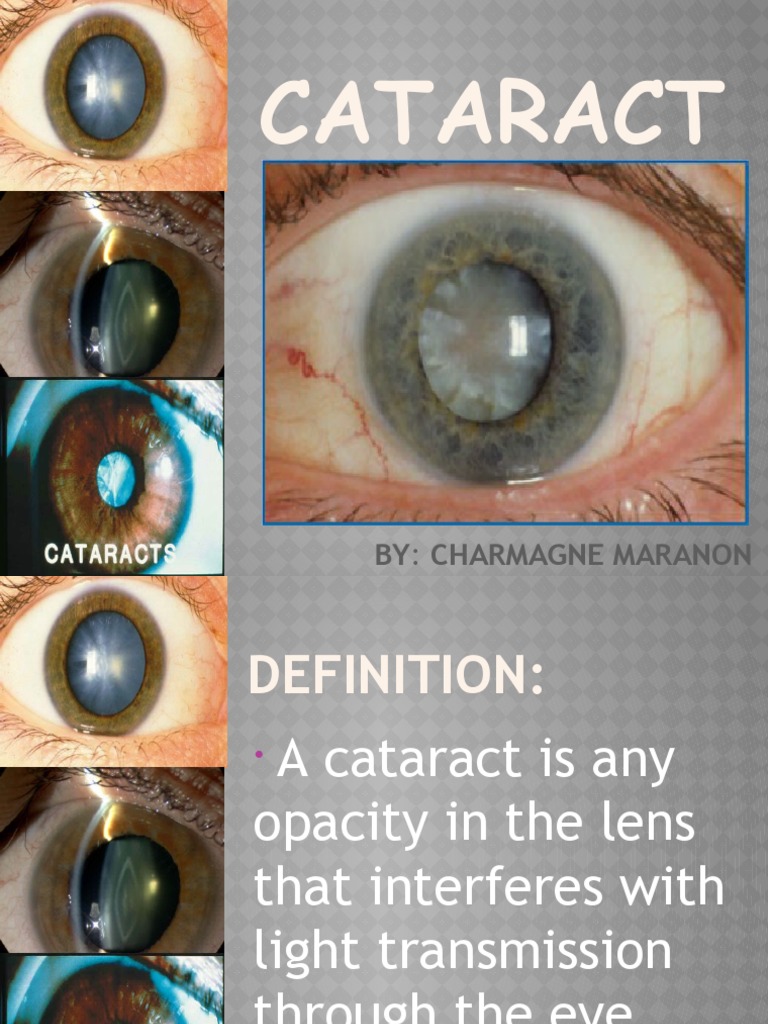 Cataract Definition