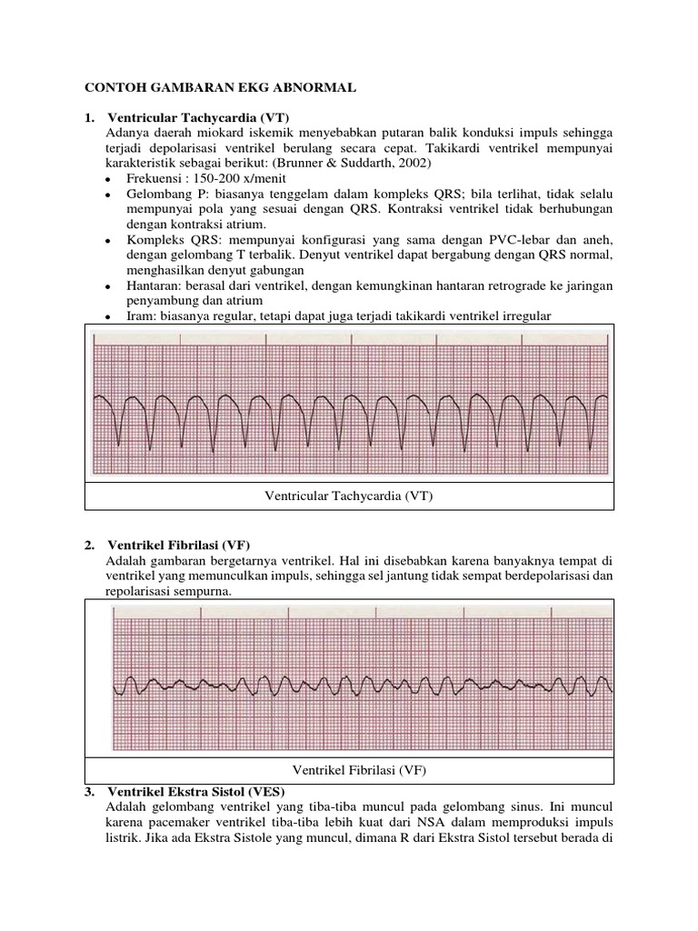 Contoh Gambaran Ekg Abnormal | PDF