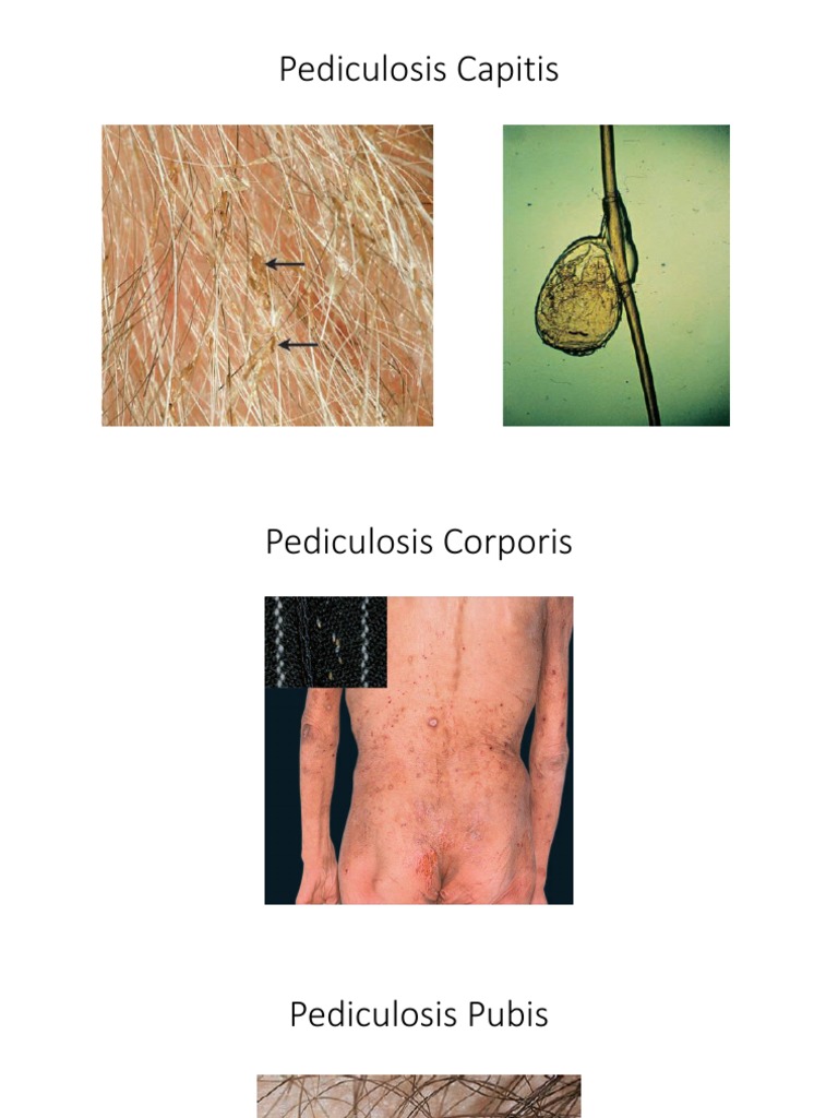 A Guide to Common Parasitic Skin Infections: Pediculosis, Scabies, and ...