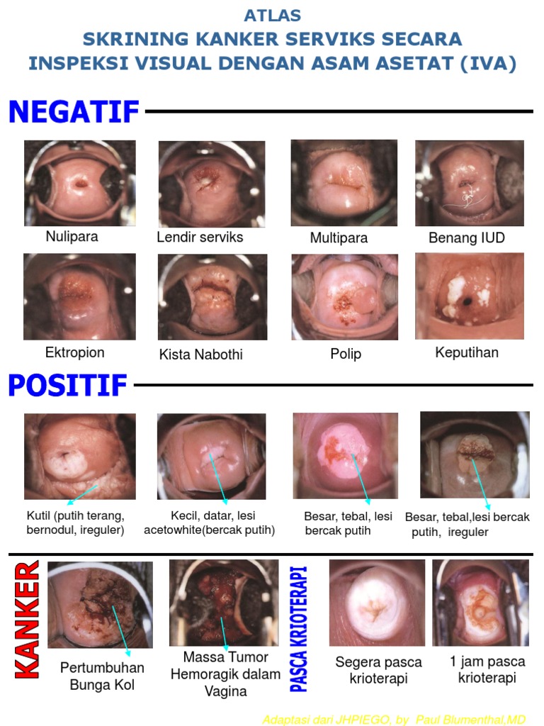 Skrining Kanker Serviks dengan IVA | PDF