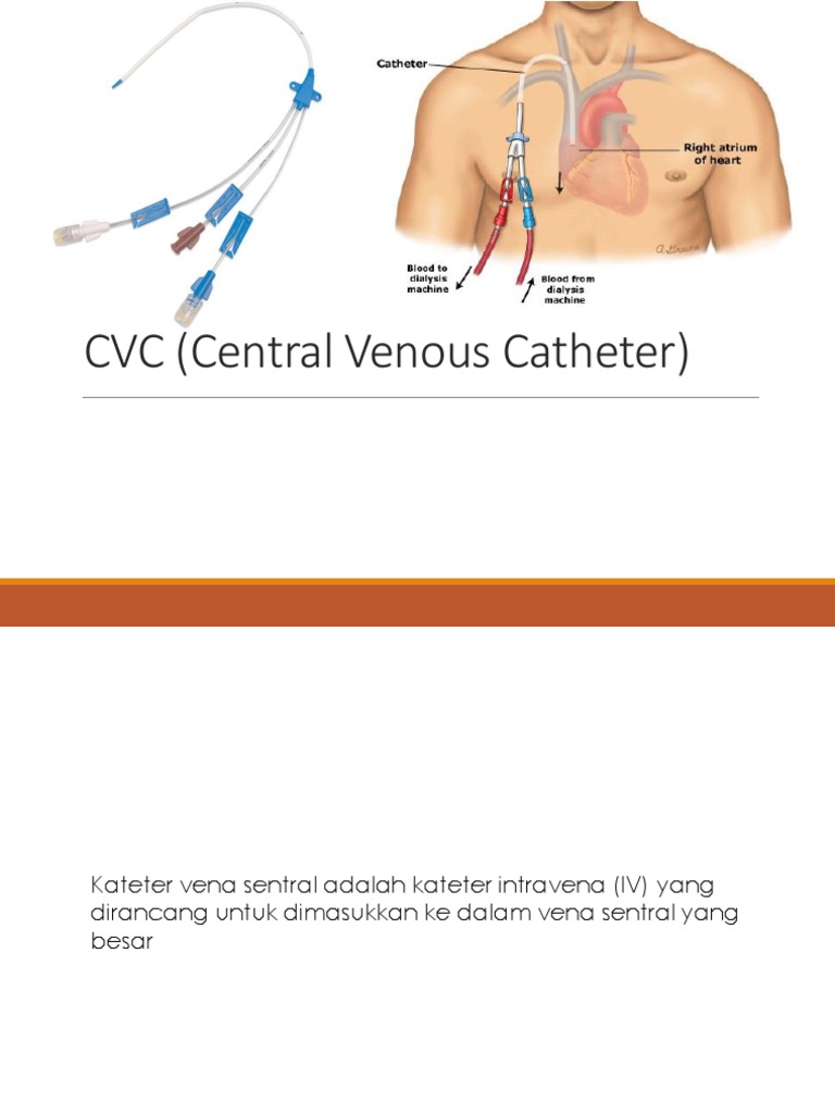 Pemasangan dan Risiko CVC pada Pasien | PDF