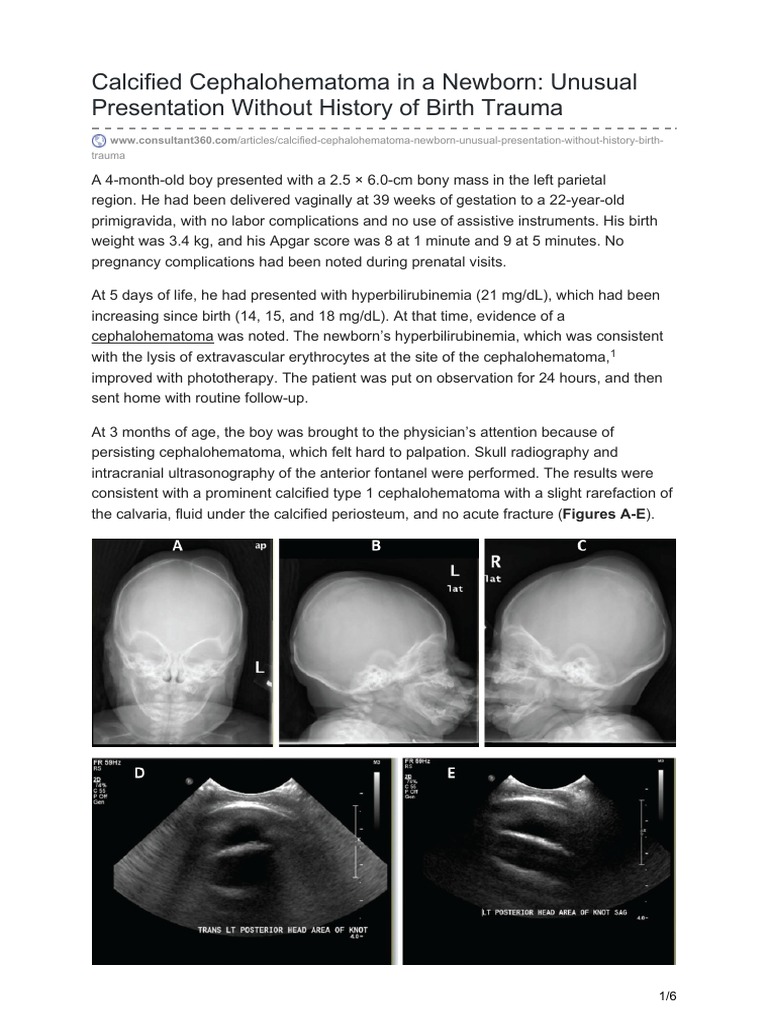 Calcified Cephalohematoma in A Newborn Unusual Presentation Without ...