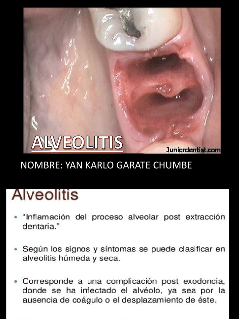 ALVEOLITIS | PDF