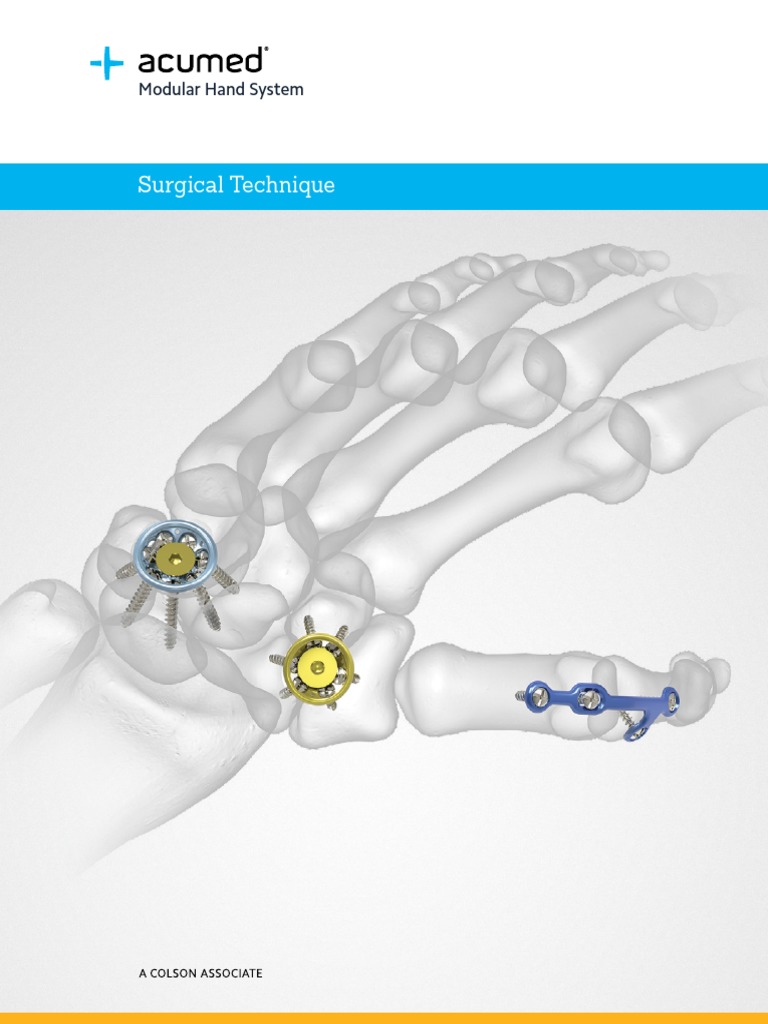 Acumed Surgical Technique Modular Hand System HNW00 04 A PDF | PDF ...