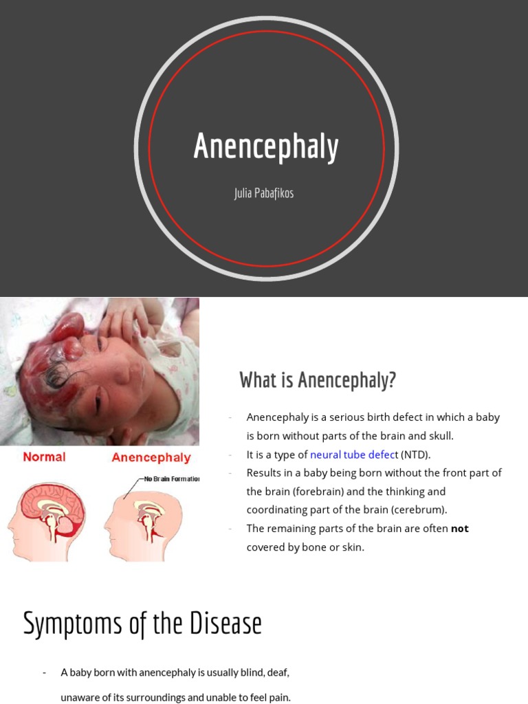 Anencephaly | PDF | Clinical Medicine | Health Sciences