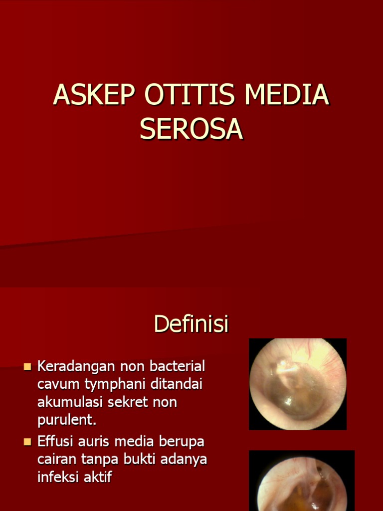 Otitis Media Serosa | PDF