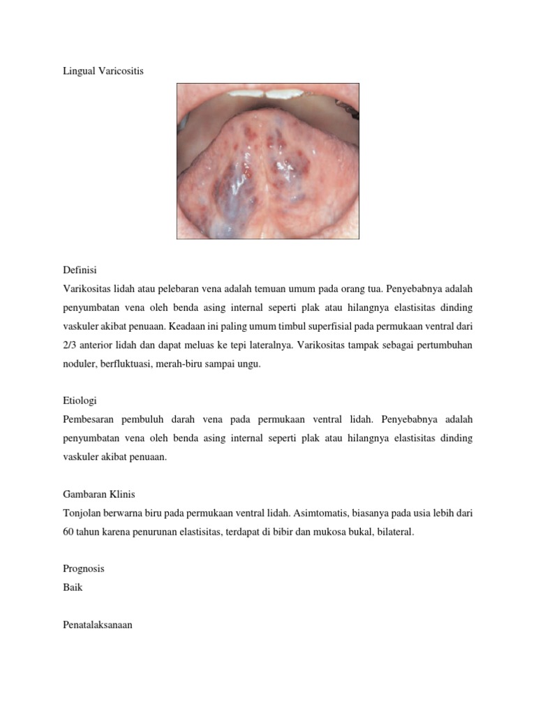 Lingual Varicositis