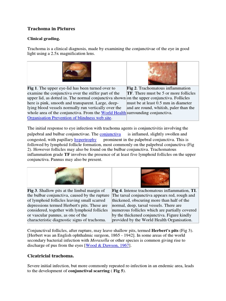 Trachoma in Pictures: Clinical Grading | PDF | Ophthalmology | Medical ...