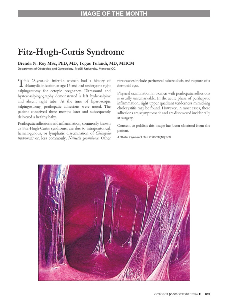 Fitz-Hugh-Curtis Syndrome Overview | PDF