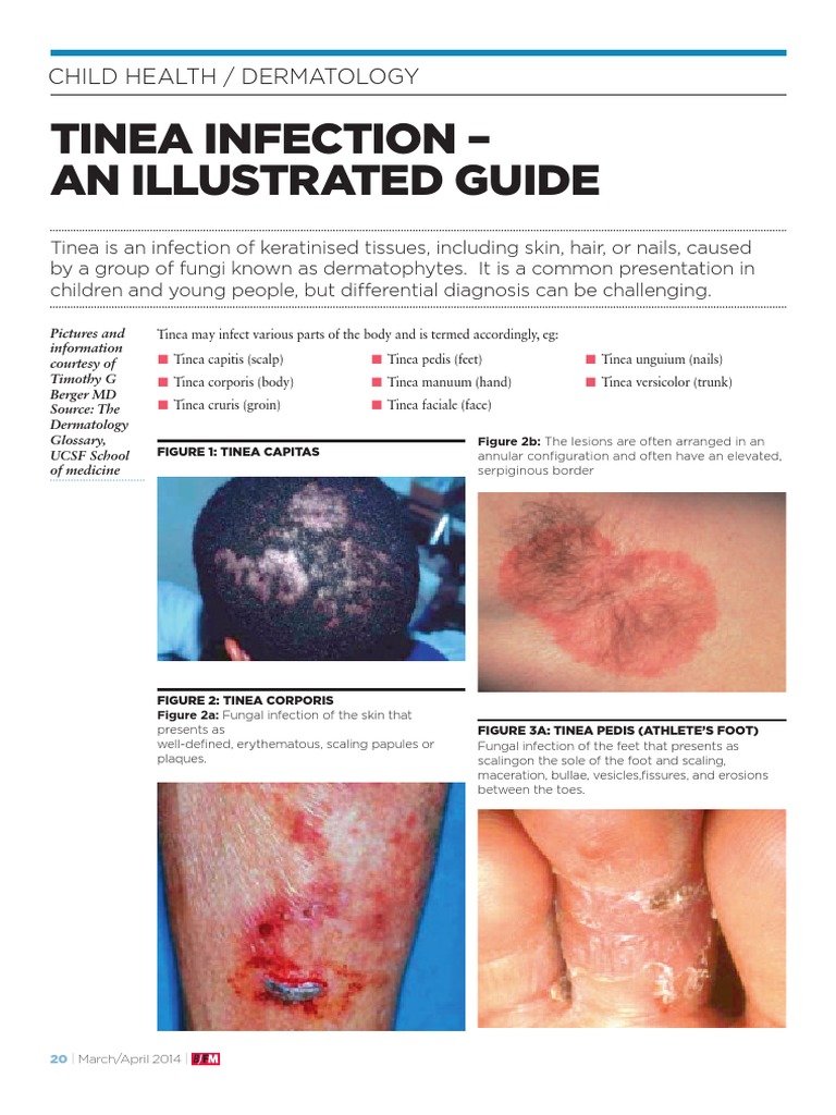 Illustrated Guide to Tinea Infections | PDF | Cutaneous Conditions ...