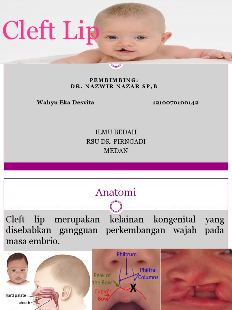 Cleft Lip: Definisi, Epidemiologi, dan Penanganan | PDF