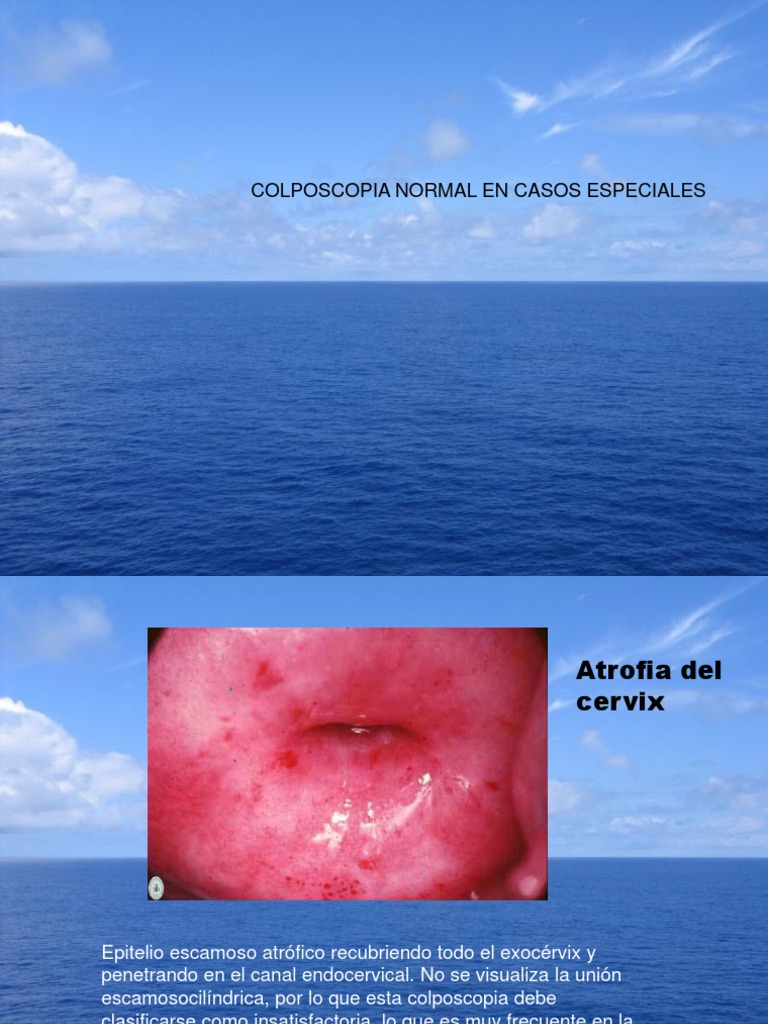 Colposcopia Normal | PDF | Epitelio | Vagina