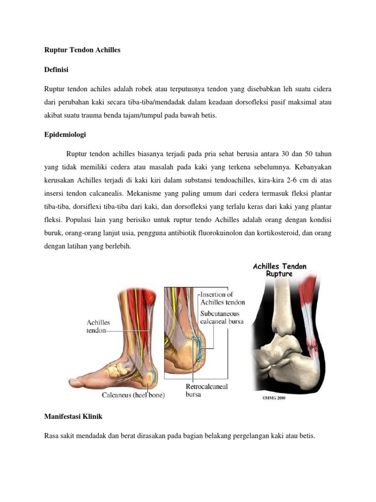 Ruptur Tendon Achilles | PDF