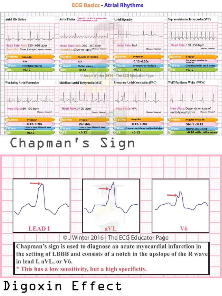 ECG Flashcards