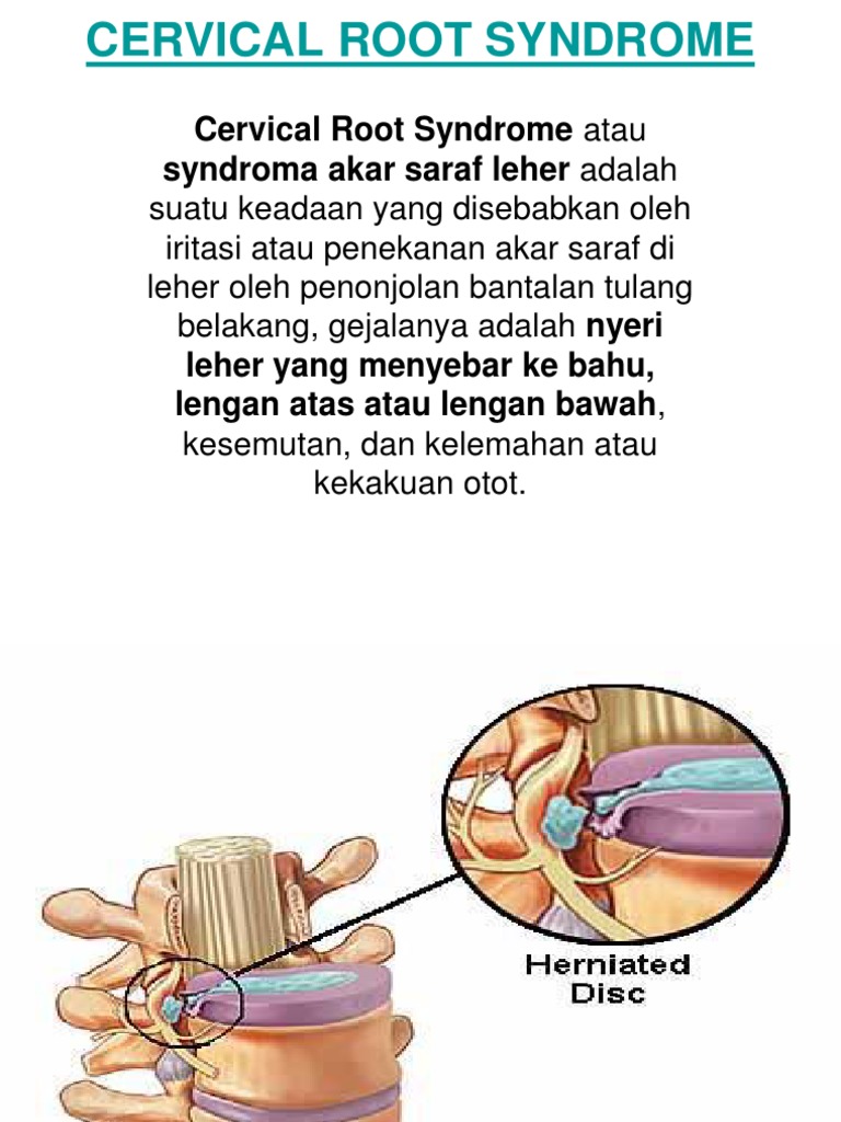 Cervical Root Syndrome | PDF
