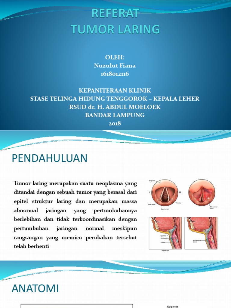 Tumor Laring | PDF
