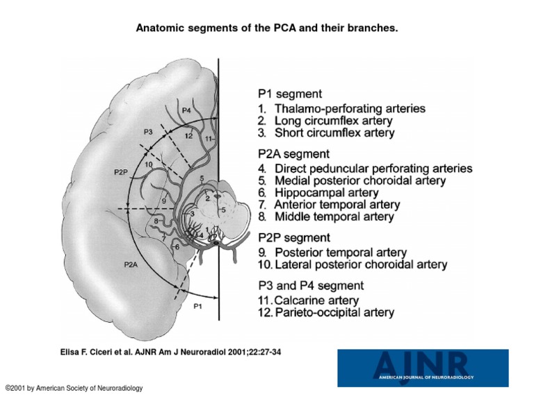 Anatomic Segments of The PCA and Their Branches.: Elisa F. Ciceri Et Al ...