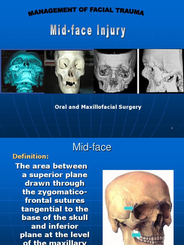 Mid-Face Injury (Trad) | PDF | Human Anatomy | Primate Anatomy