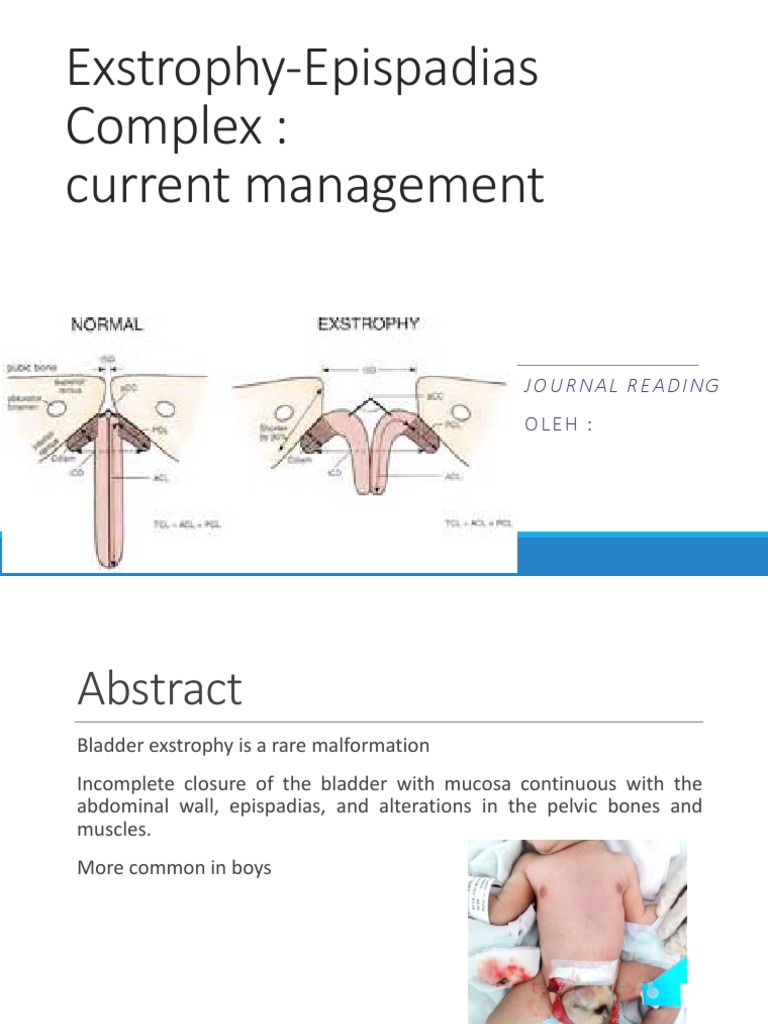 Exstrophy-Epispadias Complex: Current Management: Journal Reading | PDF | Urinary Incontinence ...